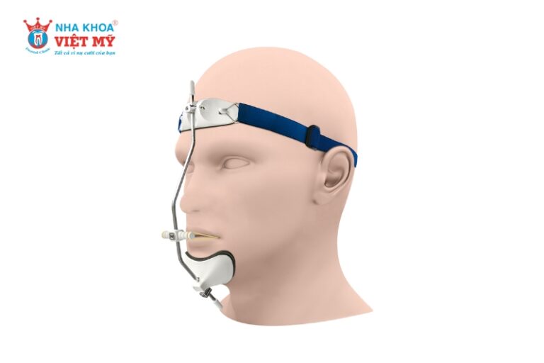 Khí cụ Facemask chỉnh nha là gì? Vai trò như thế nào?