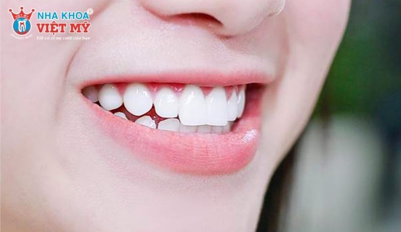 Răng sứ răng thỏ: Xu hướng thẩm mỹ, ưu nhược điểm cần biết